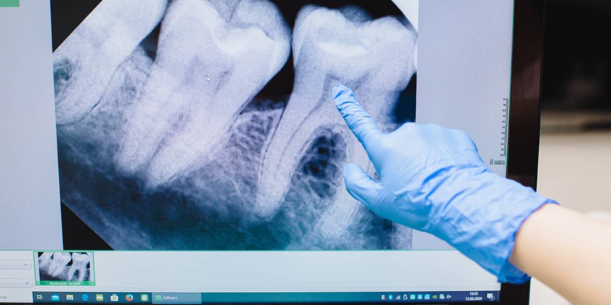 Wisdom Teeth Removal Procedure San Francisco, CA